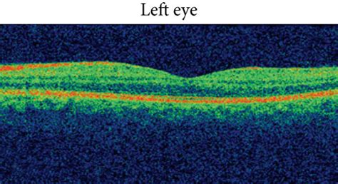 A L Serial Oct Scans Showing The Evolution Of Maculopathy Obtained Download Scientific
