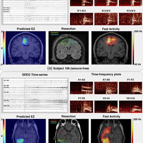 two exemplar cases illustrating the epileptogenic zone fingerprint