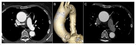 Acute Limited Intimal Tear Lit In The Ascending Aorta Stanford Type