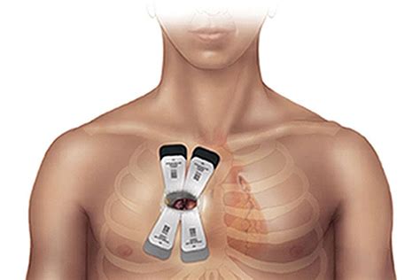 Key Hole Heart Surgery With Small Incisions Come Great Responsibilities Consultant