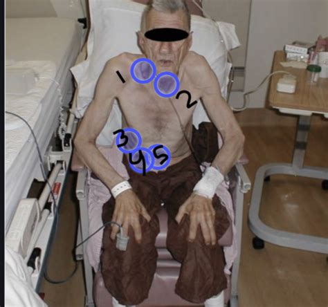 Peds Mod 5 Respiratory Flashcards Quizlet