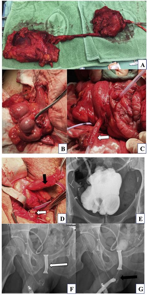 The Use Of Ileocecal Pouch With Appendix As An Urethral Substitute In