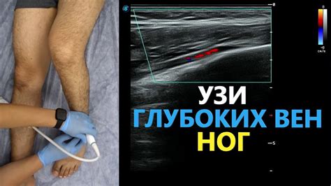 УЗИ Глубоких Вен Нижней Конечности с демонстрацией датчика Пишем ПРОТОКОЛ вместе Youtube