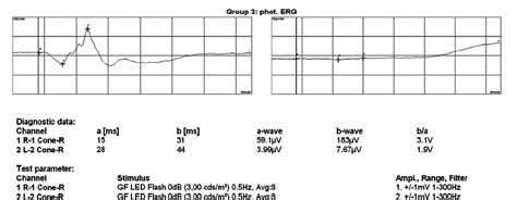 ERG Of The Left Eye Shows No Response Download Scientific Diagram