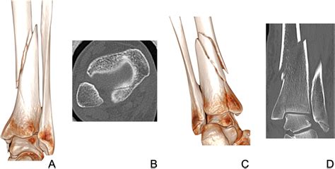 Illustration Of 3d Surface Rendering A And Axial Ct Scan B Of A