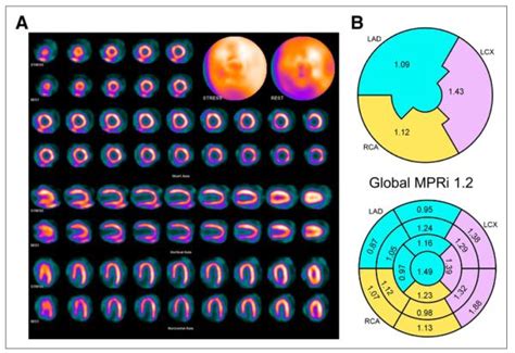 Quantification Of Myocardial Perfusion Reserve Using Dynamic Spect Imaging In Humans A