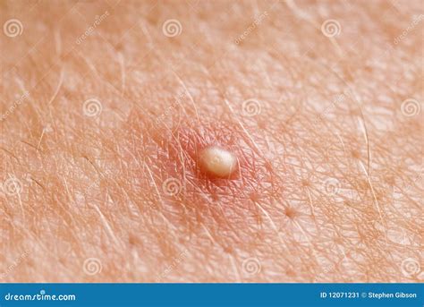 Whitehead Zit Stock Image Image Of Pore Eruption Ugly 12071231