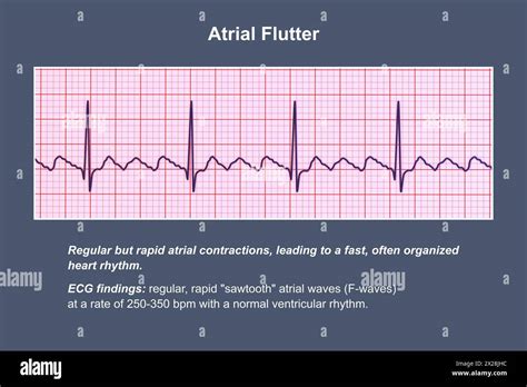 ECG In Atrial Flutter Illustration Stock Photo Alamy