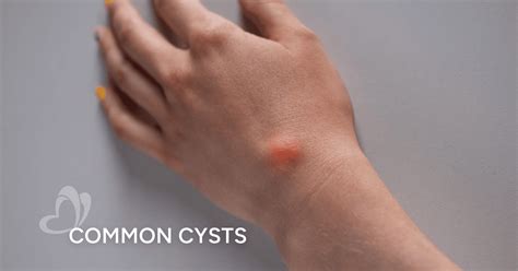 Skin Cyst How To Diagnose And Treat Different Types Thomson Medical