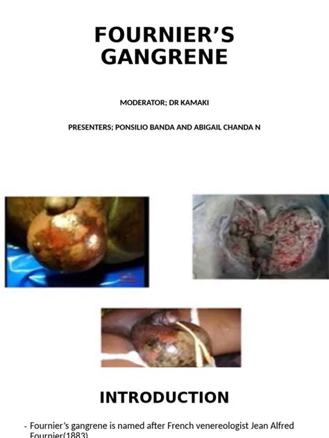 Fourniers Gangrene Overview And Management Pdf Thrombus Sepsis