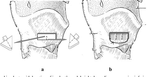 Figure 2 From Novel Technique Of Silastic Implant Carving For Thyroplasty Type I Surgery