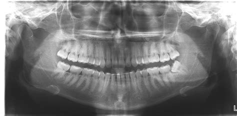 Wisdom Teeth St Kilda Dentist