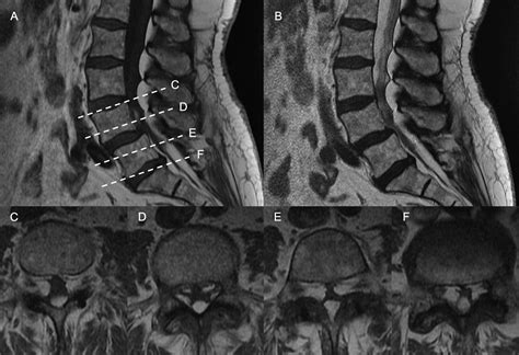 Indentation Of The Lumbar Thecal Sac Answer Journal Of Clinical