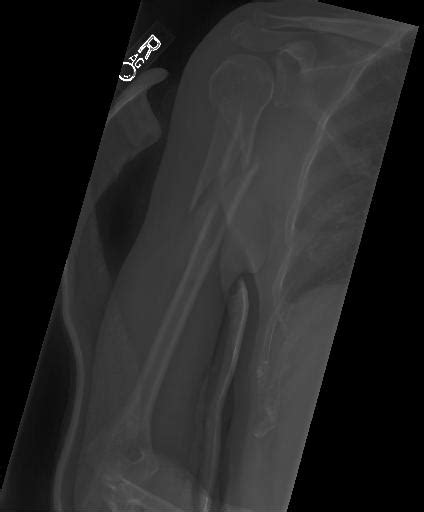 Bone Fracture Prediction Model Object Detection Dataset And Pre Trained Model By Corn Leafs