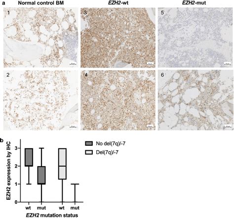 ezh2 mutations result in decreased ezh2 protein expression a