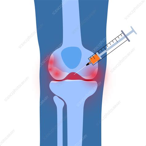 Knee Injection Illustration Stock Image F0366331 Science Photo Knee Injection Illustration Stock Image F0366331 Science Photo