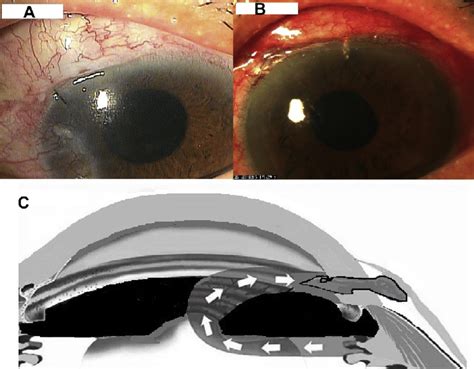 A Patients Received Trabeculectomy With Bleb Formation B Patients