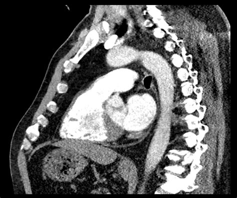 Diagram Of Coronal Ct Of Chest Quizlet