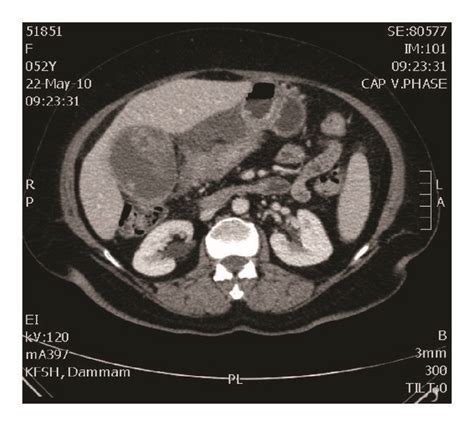 A And B Abdominal Ct Scan Demonstrating A Large Exophytic Mass