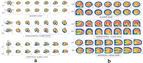 A Short And Long Axis 201 Thallium Scintigraphy Images Showing