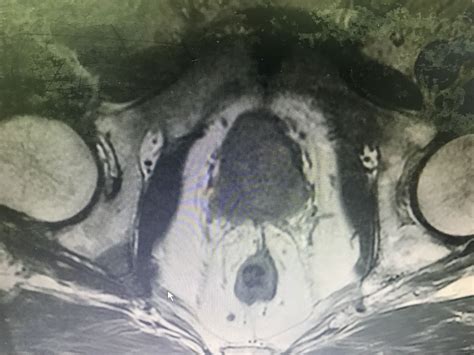 机器人辅助前列腺癌根治术