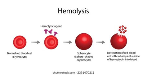 Hemolysis Plasma 스톡 벡터 및 벡터 아트 55개 Shutterstock