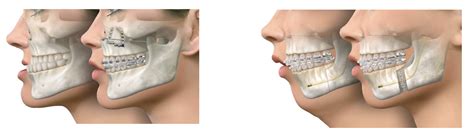 QuÉ Es La CirugÍa OrtognÁtica