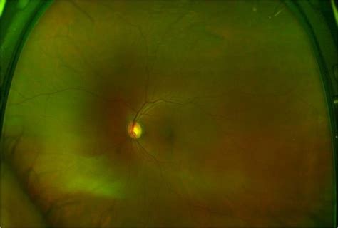 Optomap Retinal Exam A Picture Is Worth 1000 Words