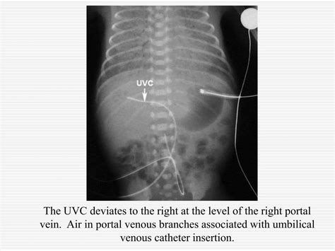 Neonatal Umbilical Venous Catherization Radiology Ppt