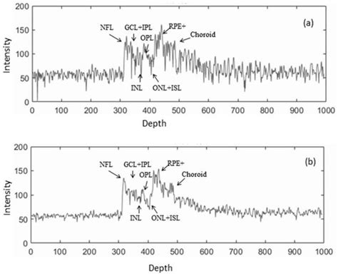 optical coherence tomography denoising method based on bilateral random