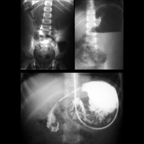 Volvulus X Ray Infant