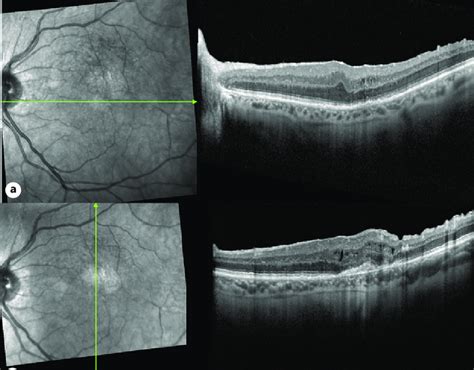 Oct Scans Performed At The Last Follow Up Visit A Oct Scan Crossing