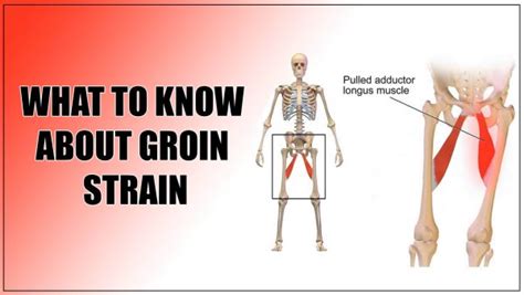 Expert Physical Therapy Guide To Recover Groin Strain Oklahoma Physical Therapy