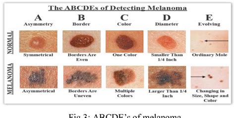 Table 1 From Identification Of Melanoma In Dermoscopy Images Using