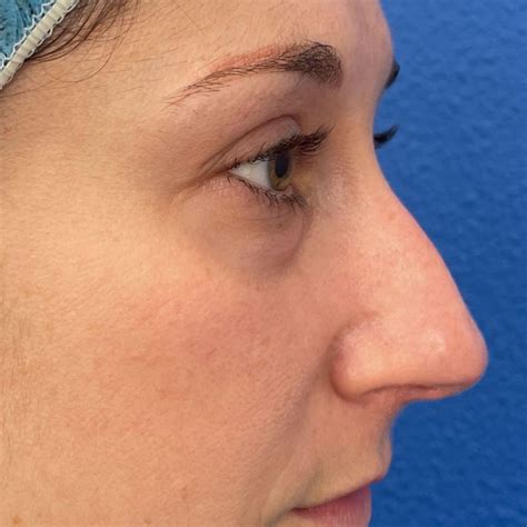 Eye Surgery Lower Eyelid 2 Barbarino Surgical Arts
