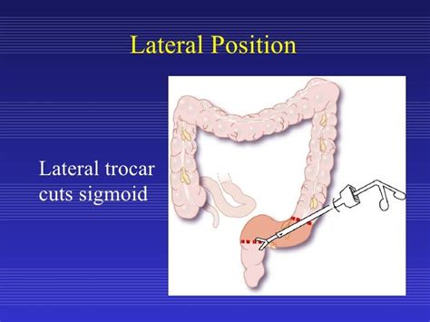 Laparoscopic Sigmoid Colon Resection For Diverticular Disease