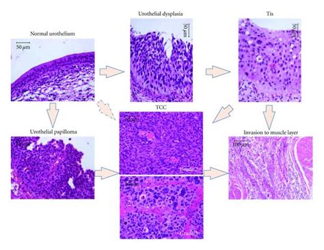 Natural History Of Bladder Cancer Transitional Cell Carcinoma Tis Download Scientific