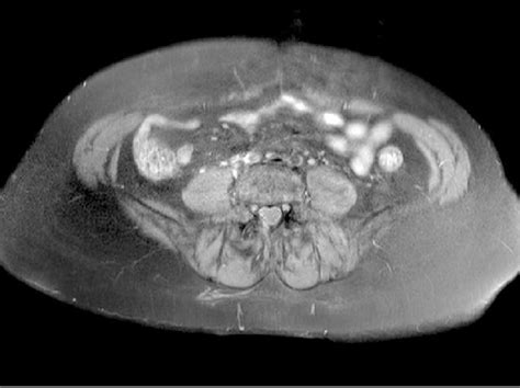 Mucocele Of Appendix Semantic Scholar