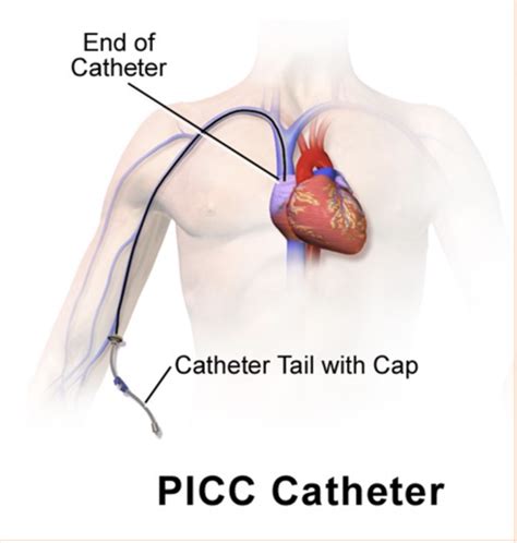 Upper Extremity Venous Duplex And Gsv Ssv Vein Mapping Flashcards Quizlet