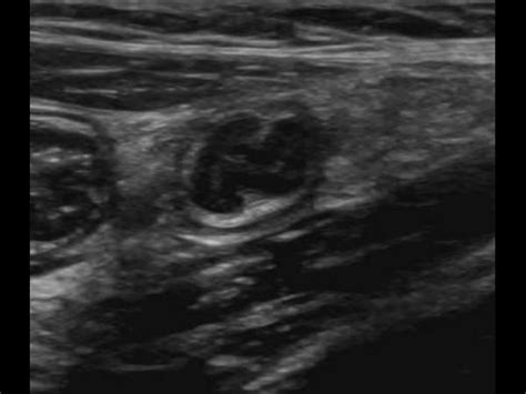 Abdomen And Retroperitoneum 1 5 Appendix Case 1 5 5 Mucocele Or Cystadenoma Of The Appendix