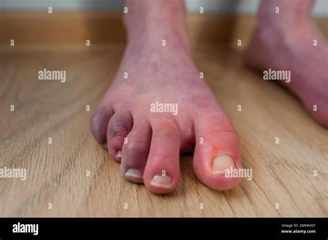 Closeup Of Feet Of Person With Orthostatic Intolerance Pots With Dark Discoloration Upon