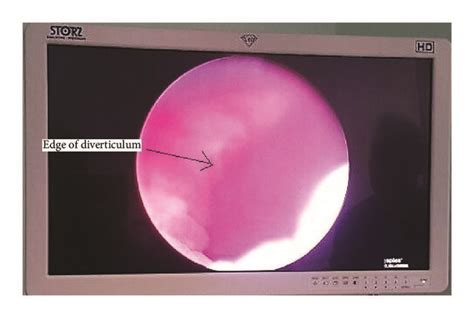 A Open Prostatic Fossa B Bladder Diverticulum Download Scientific Diagram