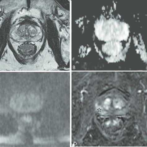 A 66 Year Old Man With Psa 98µgl On T2 Wi A The Pz Shows Diffuse