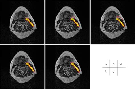 Comparison Of Manual Segmentation And A 2 5D Generative Adversarial Download Scientific