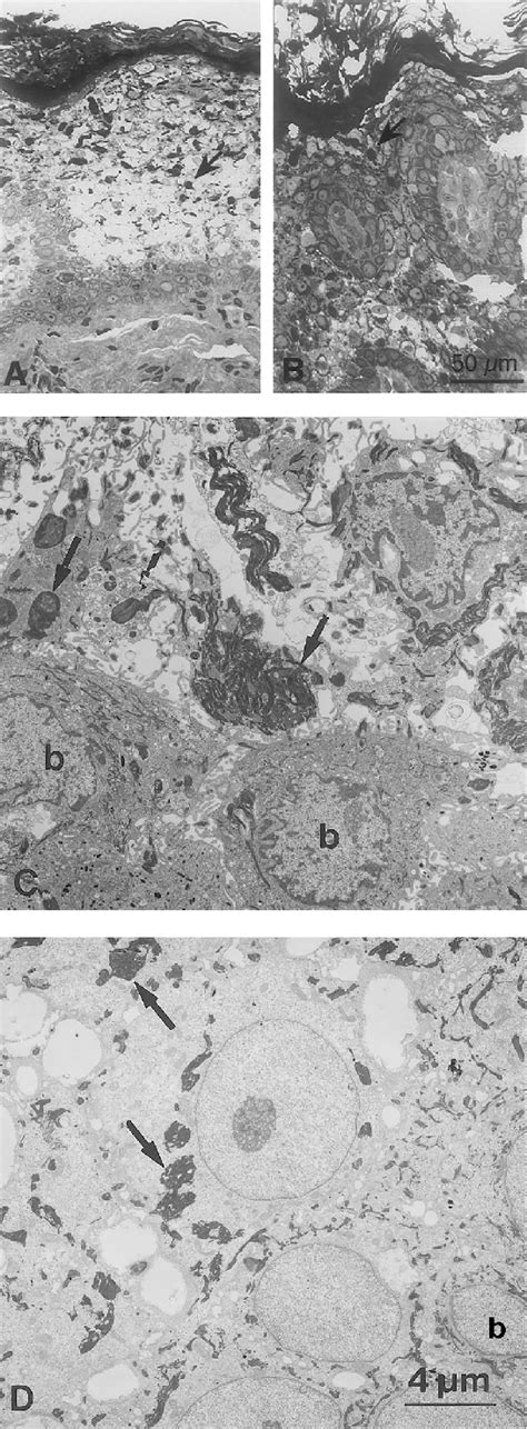 Figure 6 From Cyclic Ichthyosis With Epidermolytic Hyperkeratosis A Phenotype Conferred By