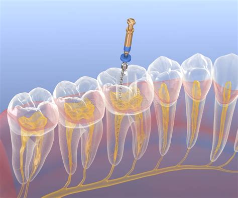 Endodontic Root Canal Treatment Process Medically Accurate Tooth 3d