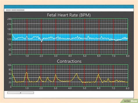 How To Read A Contraction Monitor During Labor