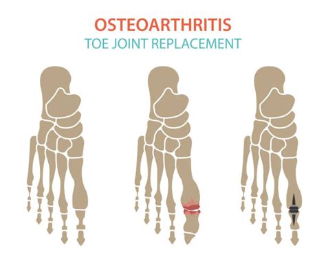 100 Joint Replacement Stock Illustrations Royalty Free Vector