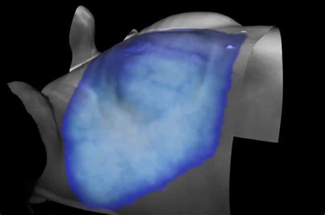 Algorithm Enhances Cherenkov Based Dose Verification Physics World