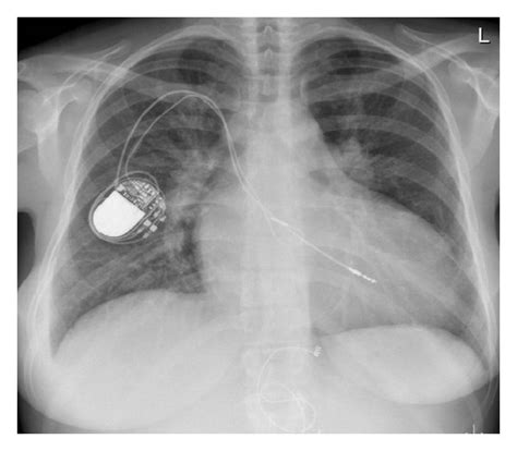 32 Year Old Patient With Severe Biventricular Dysfunction After Atrial Download Scientific